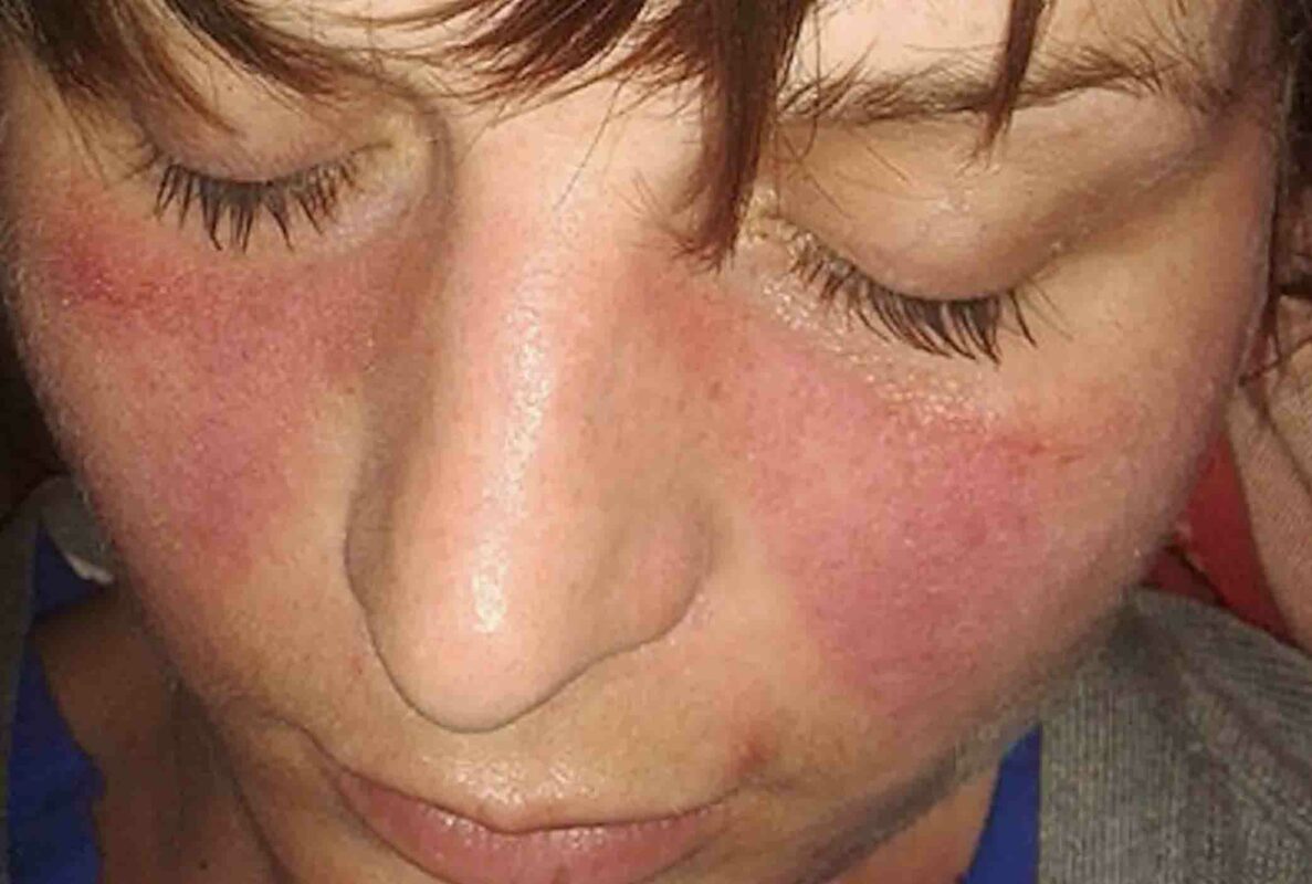 12 Jenis Penyakit Autoimun, Kamu Wajib Tahu Perbedaannya! - Rukita