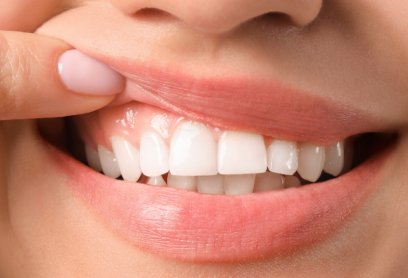 Penyebab Gusi Bengkak | Kenali Gejala, Cara Mengobati dan Mencegah