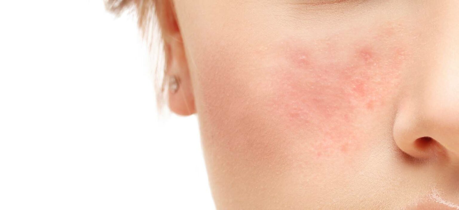 12 Jenis Penyakit Autoimun, Kamu Wajib Tahu Perbedaannya! - Rukita